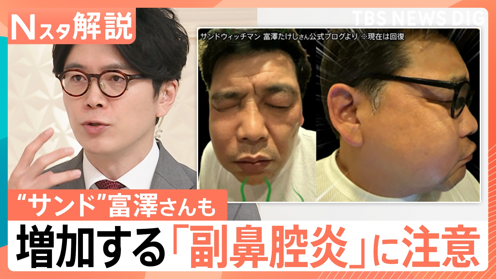 TBS NEWS DIG Powered by JNN 花粉ピーク後に注意したい“鼻トラブル”【Nスタ】 | 無料見逃し配信中！＜TBS FREE＞